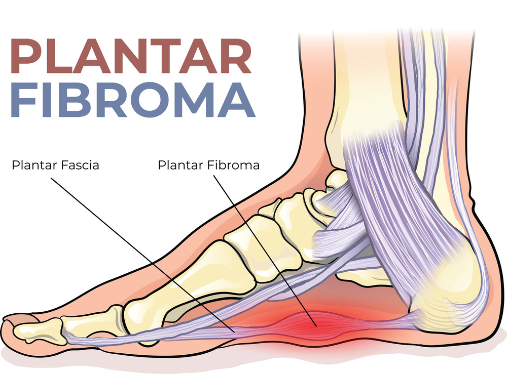 Blog | How to Treat a Plantar Fibroma Burleson, Fort Worth, TX
