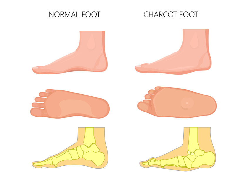 3 Stages of Charcot Foot: Symptoms and Treatment Options | Dr. Gary Driver